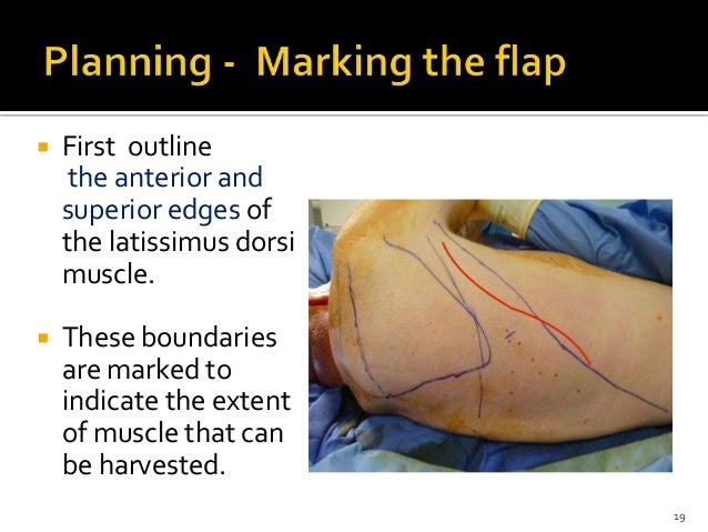 Free LD flap for scalp reconstruction DR VIPIN V NAIR