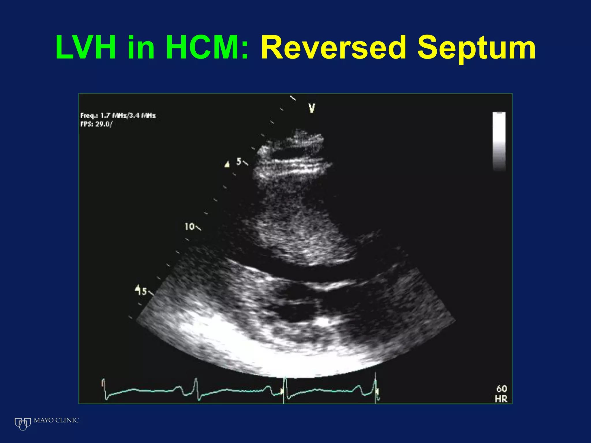 Freeman hypertrophic-cardiomyopathy | PDF