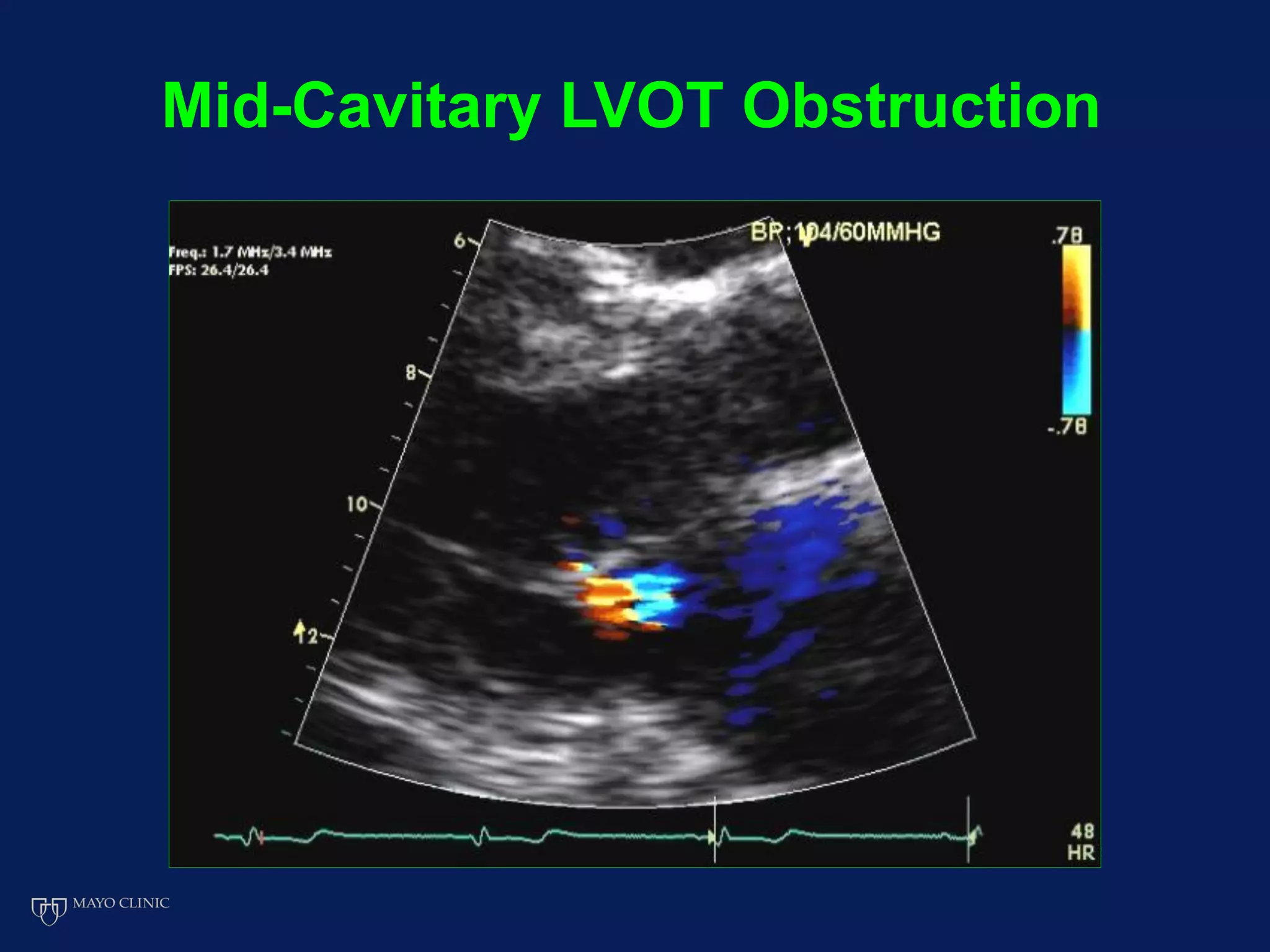 Freeman hypertrophic-cardiomyopathy | PDF