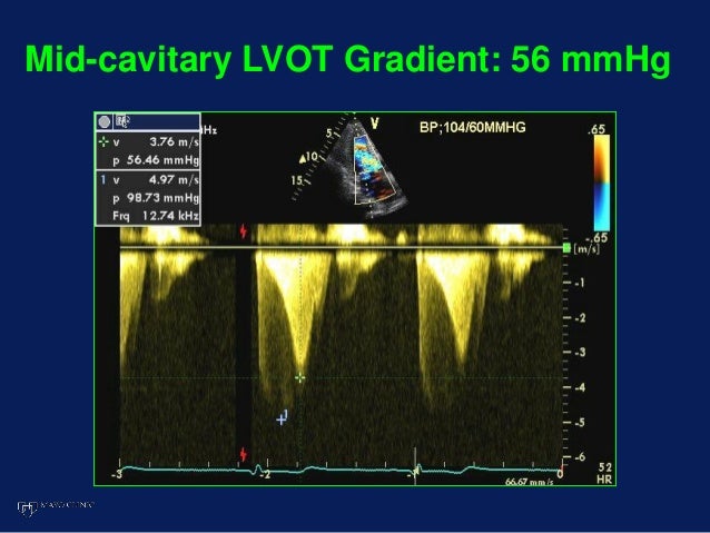 Freeman hypertrophic-cardiomyopathy