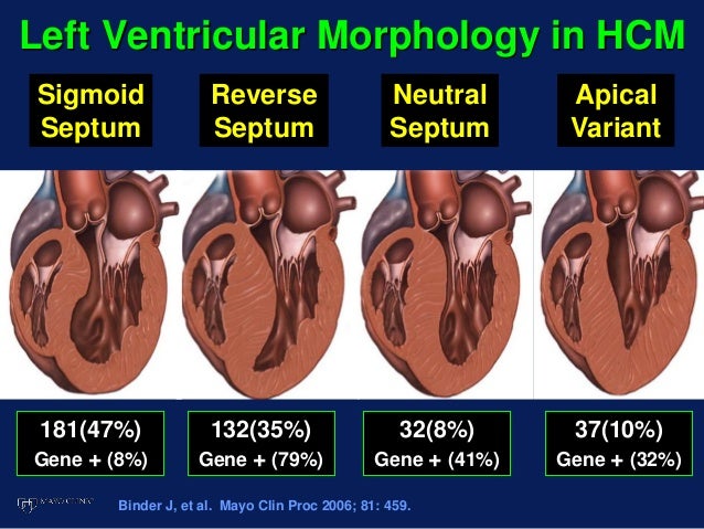 Freeman hypertrophic-cardiomyopathy