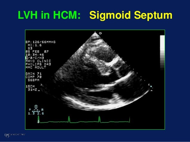 Freeman hypertrophic-cardiomyopathy