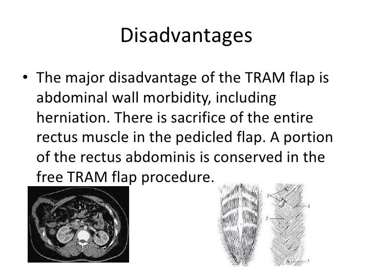 Free Tram & Latissimus Flap Breast Reconstruction