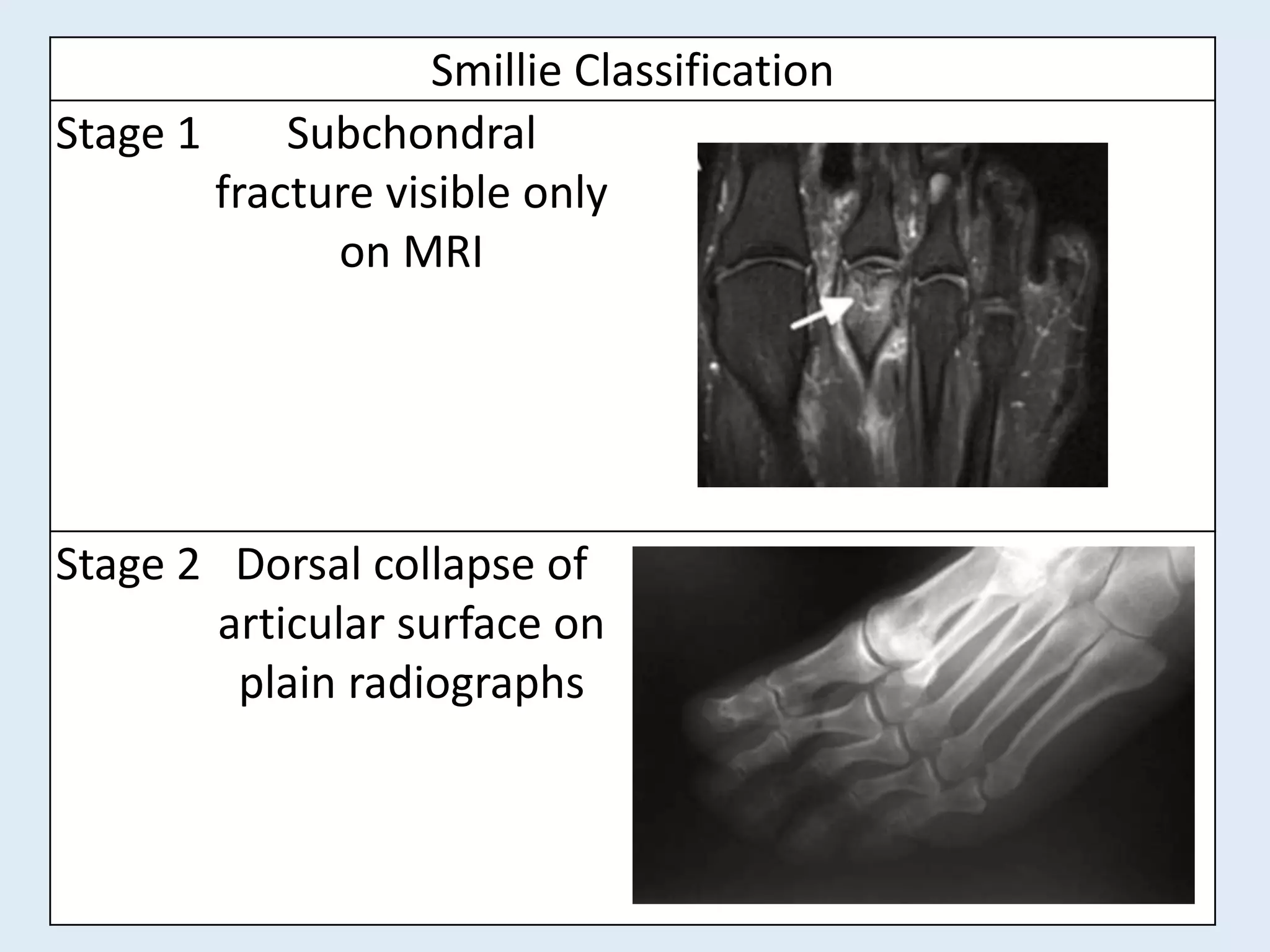 Freiberg's disease | PPTX