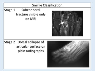 Freiberg's disease | PPTX
