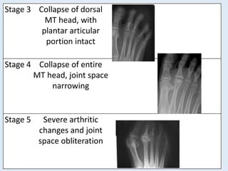 Freiberg's disease | PPTX