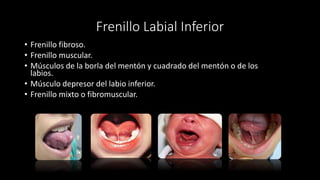 Frenillos Bucales | PPTX