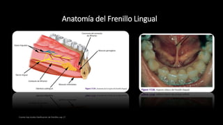 Frenillos Bucales | PPTX