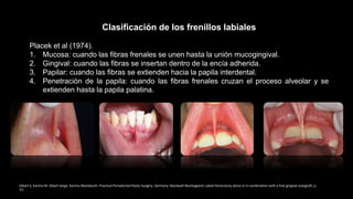 Frenillos Bucales | PPTX