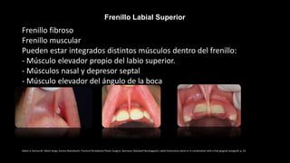 Frenillos Bucales | PPTX