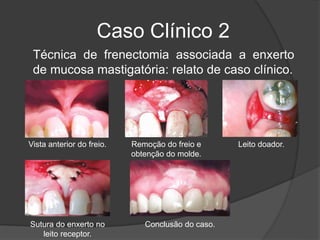 Frenectomia+e+frenotomia | PPT