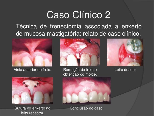 Frenectomia+e+frenotomia