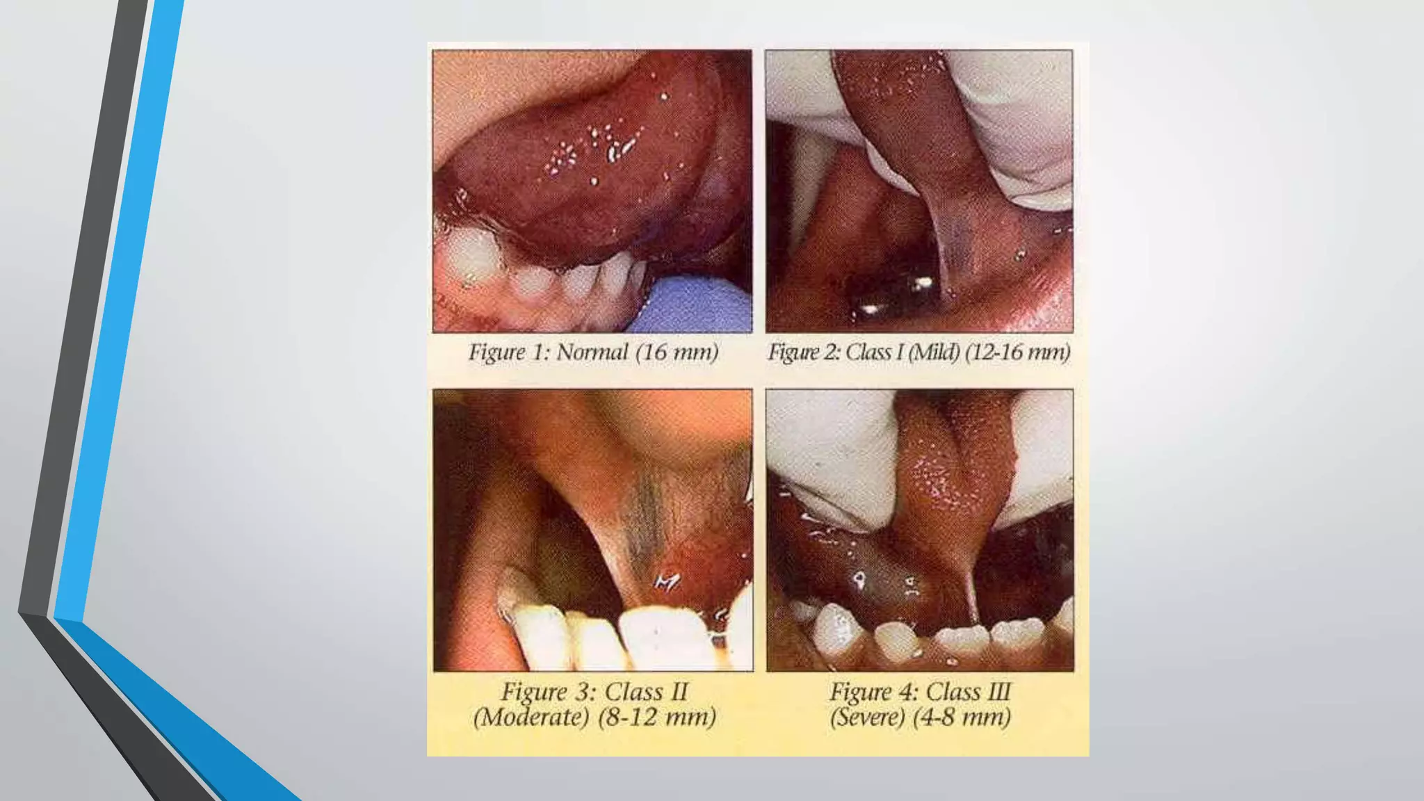 Frenectomy | PPTX