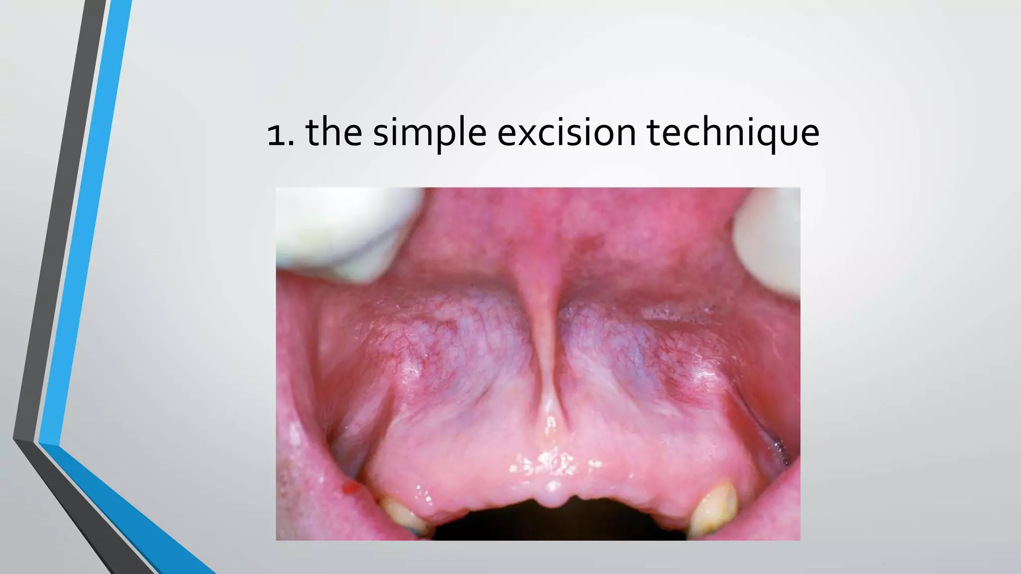 Frenectomy | PPTX