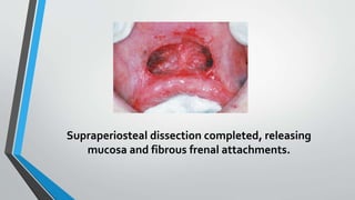 Frenectomy | PPTX