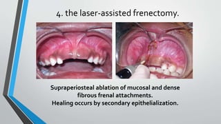 Frenectomy | PPTX