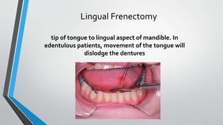 Frenectomy | PPTX | Physical Therapy | Wellness