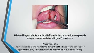 Frenectomy | PPTX
