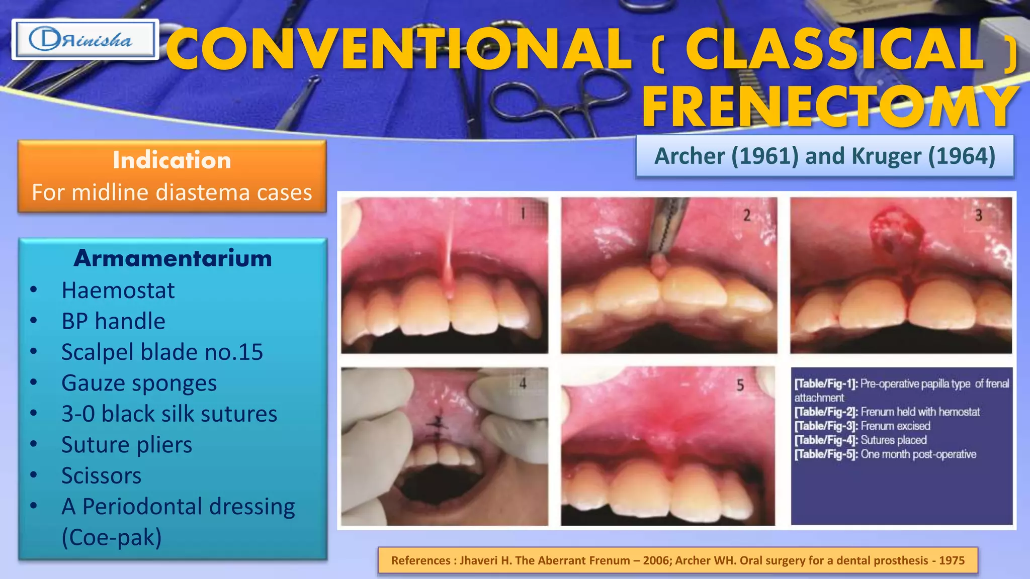Frenectomy | PPTX