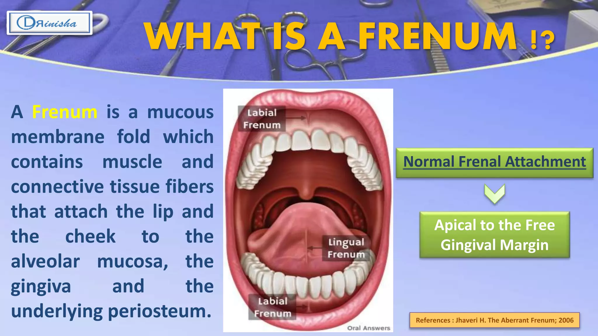 Frenectomy | PPTX