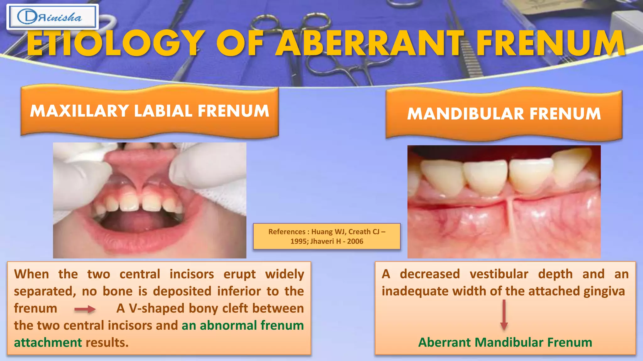 Frenectomy | PPTX