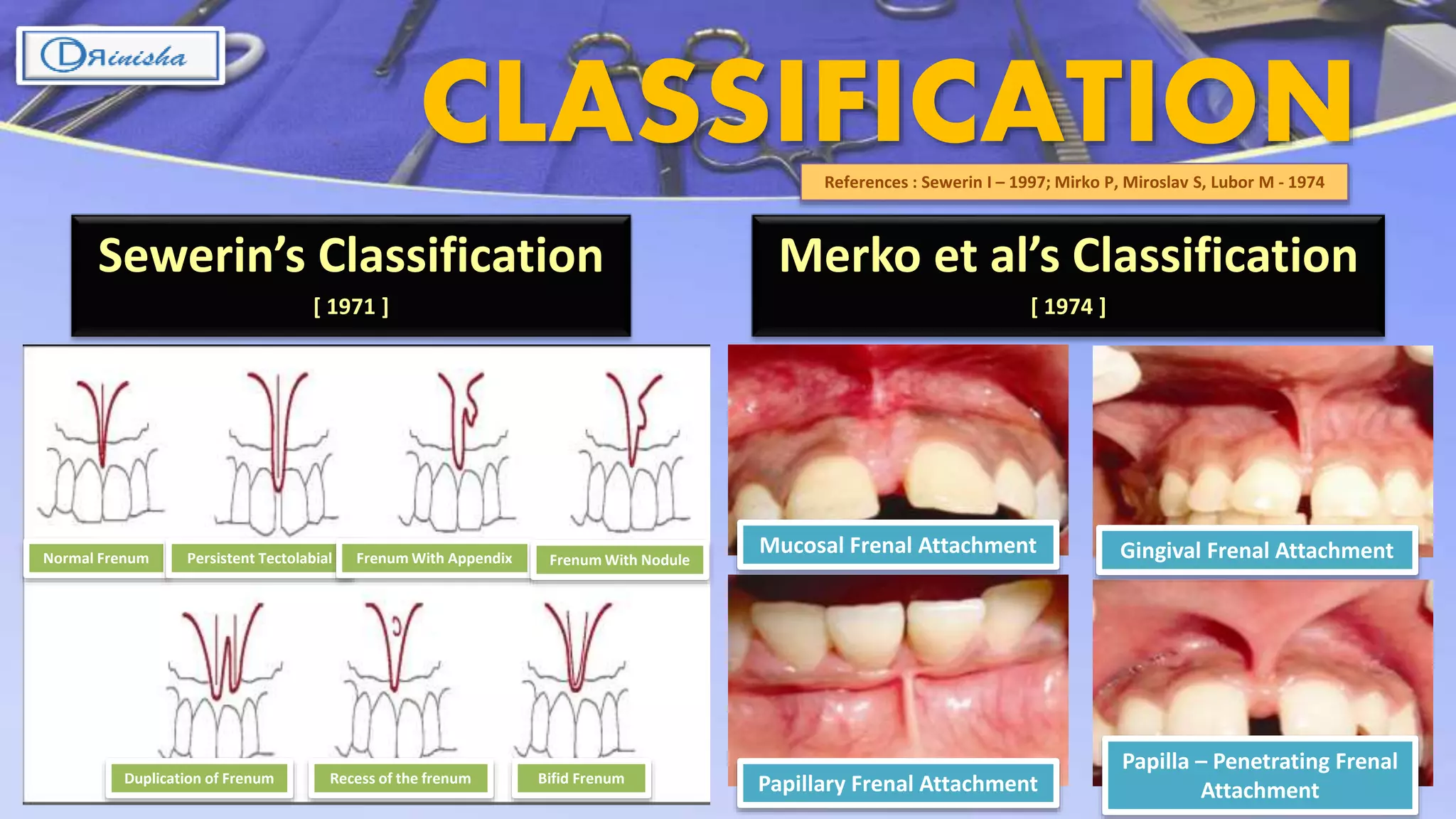 Frenectomy | PPTX