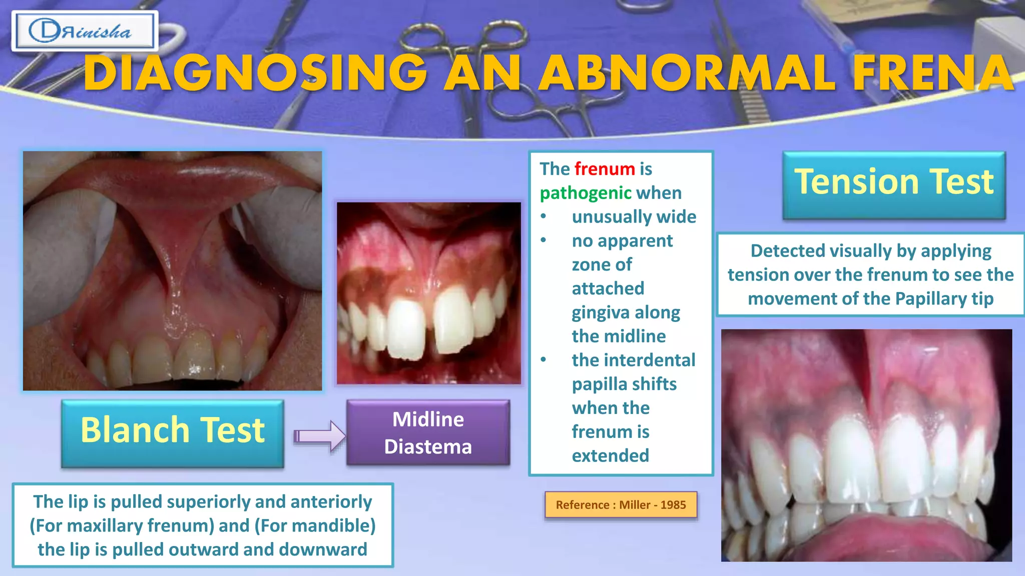 Frenectomy | PPTX