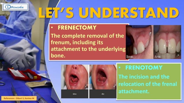 Frenectomy | PPTX | Dental Health | Diseases and Conditions