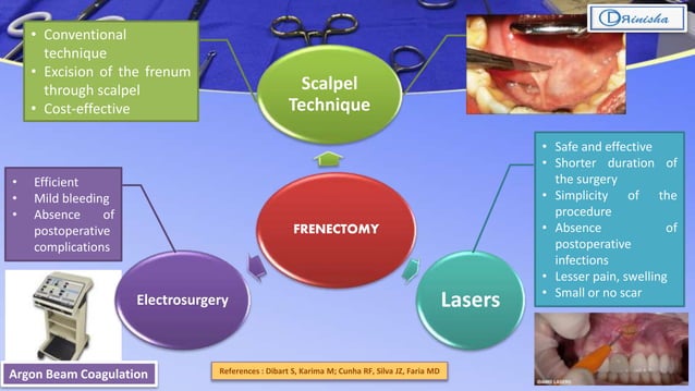 Frenectomy | PPTX | Dental Health | Diseases and Conditions