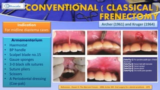 Frenectomy | PPTX