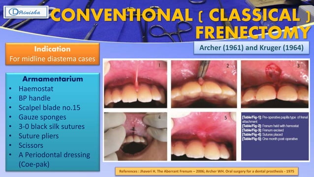 Frenectomy | PPTX | Dental Health | Diseases and Conditions