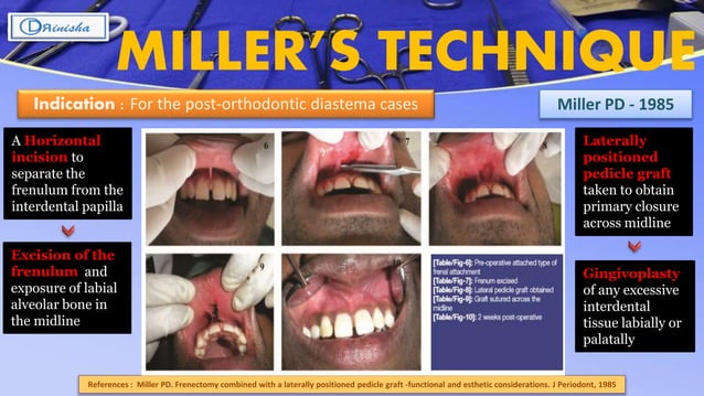 Frenectomy | PPTX | Dental Health | Diseases and Conditions