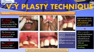 Frenectomy | PPTX
