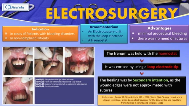 Frenectomy | PPTX | Dental Health | Diseases and Conditions
