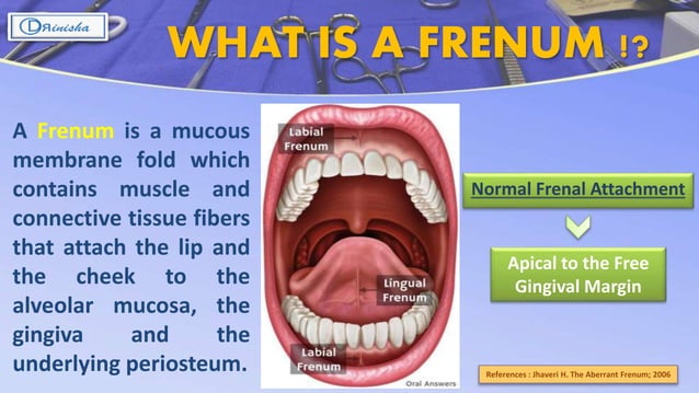 Frenectomy | PPTX | Dental Health | Diseases and Conditions