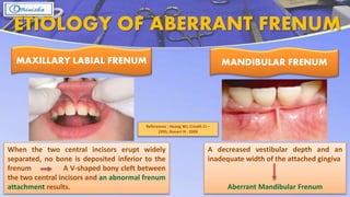 Frenectomy | PPTX