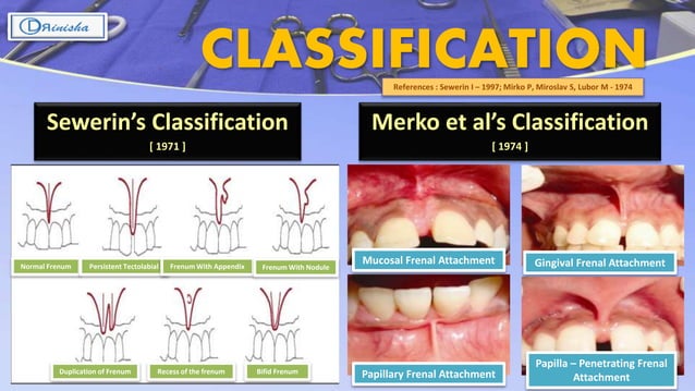 Frenectomy | PPTX | Dental Health | Diseases and Conditions