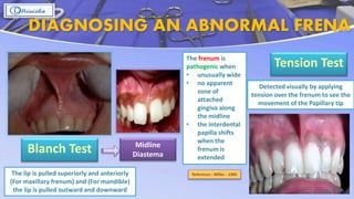 Frenectomy | PPTX