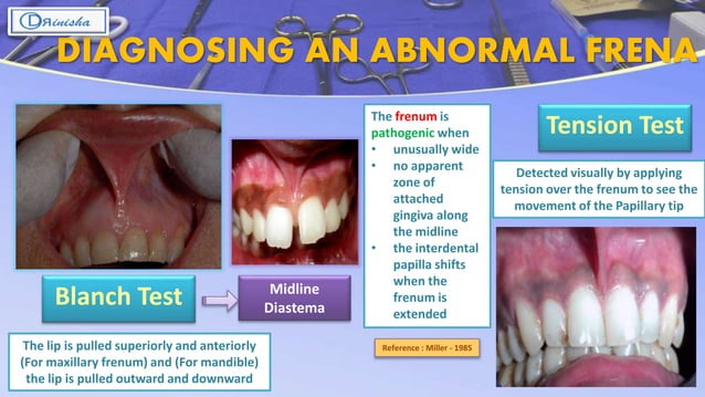 Frenectomy | PPTX | Dental Health | Diseases and Conditions