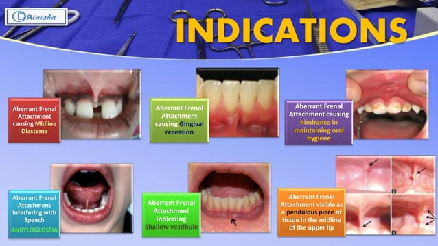Frenectomy | PPTX | Dental Health | Diseases and Conditions