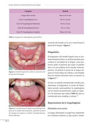 Frenillo lingual | PDF