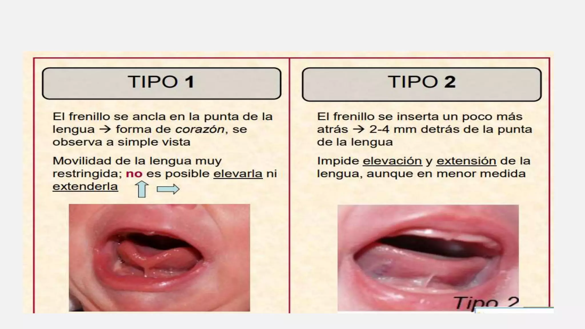 Frenillo lingual.pptx
