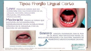 Frenillo lingual corto.pptx