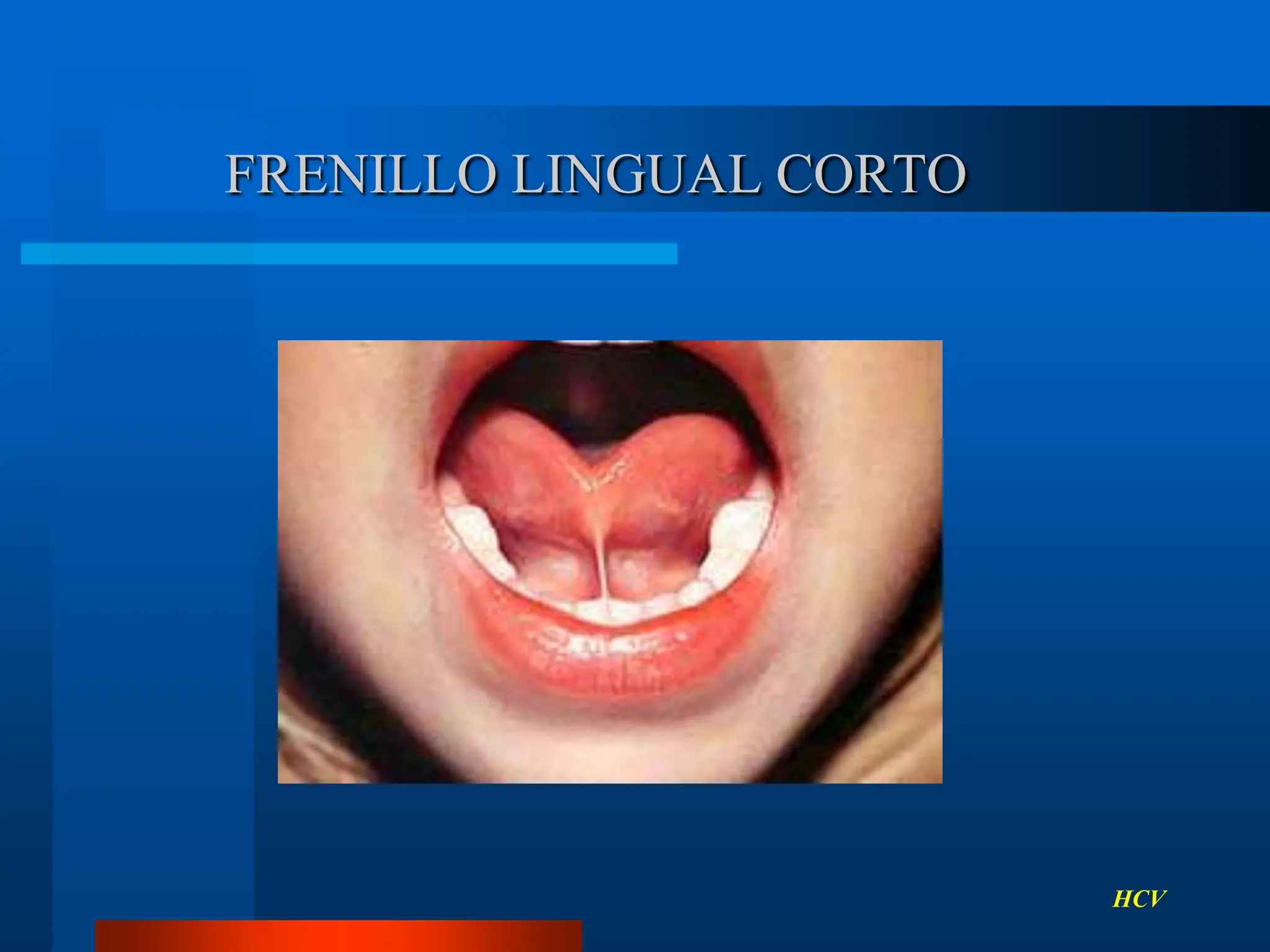 Frenillos - Frenectomia.cirugia basica y metodos | PPTX