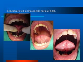 Frenillos - Frenectomia.cirugia basica y metodos | PPTX
