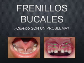Frenillos Bucales su importancia en Ortodoncia | PPTX