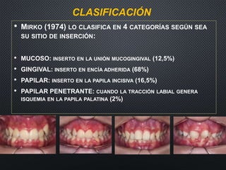 Frenillos Bucales su importancia en Ortodoncia | PPTX