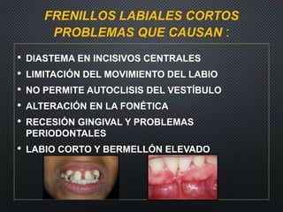 Frenillos Bucales su importancia en Ortodoncia | PPTX