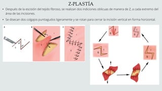 Frenillos y Vestibuloplastia.pptx