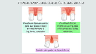 Frenillos y Vestibuloplastia.pptx